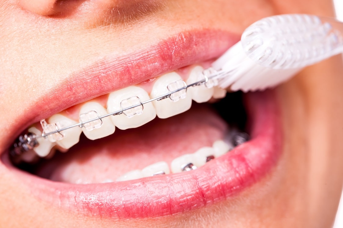 Orthodontie : soins dentaires pour corriger la position des dents ...